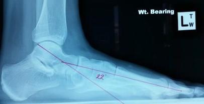 Hip Pain Treatment on The Gold Coast | Hip to Toe Podiatry